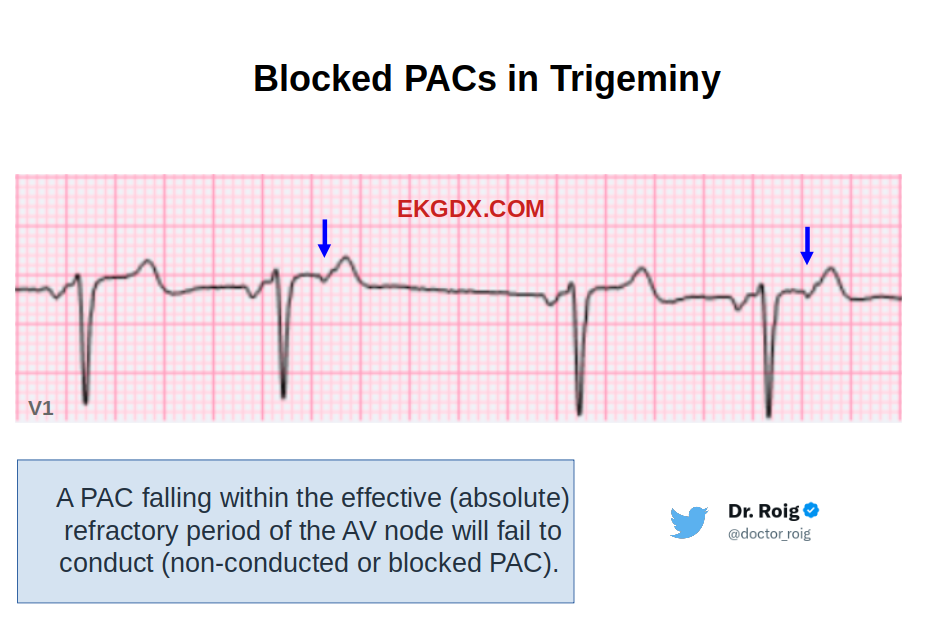Blocked Premature Atrial Contractions